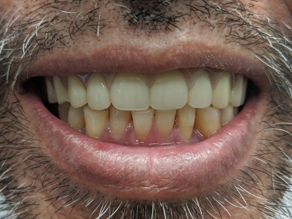 Case Study: Patient Gets Custom-Made Denture for Dental Implants ...