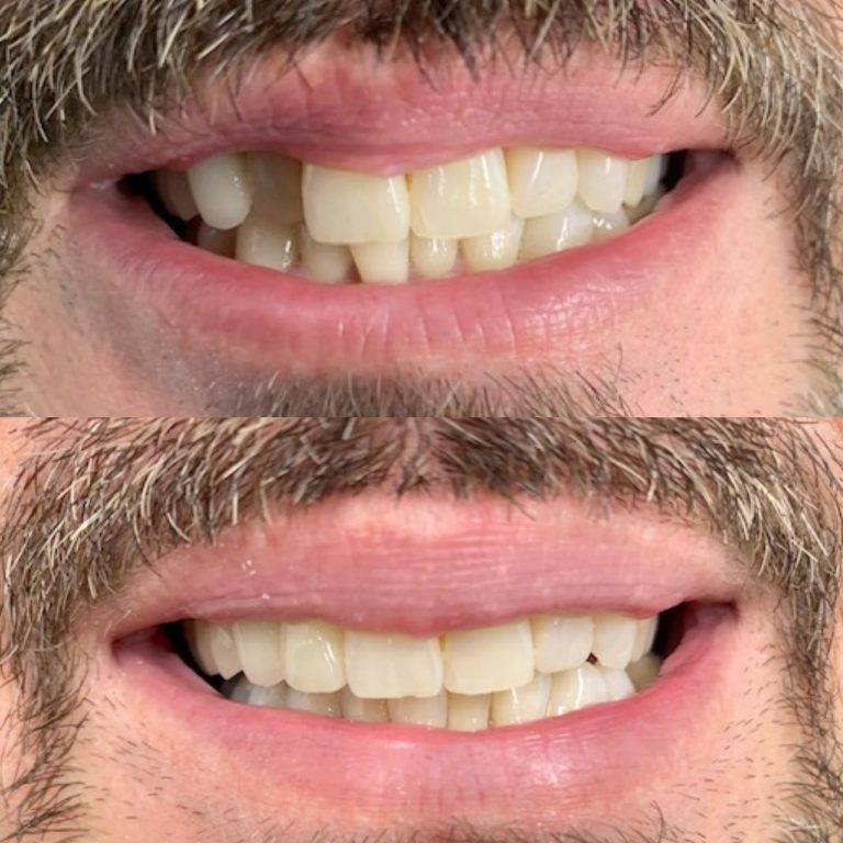 Dental Crown Corrects Misaligned Tooth for Patient | Dentist in ...